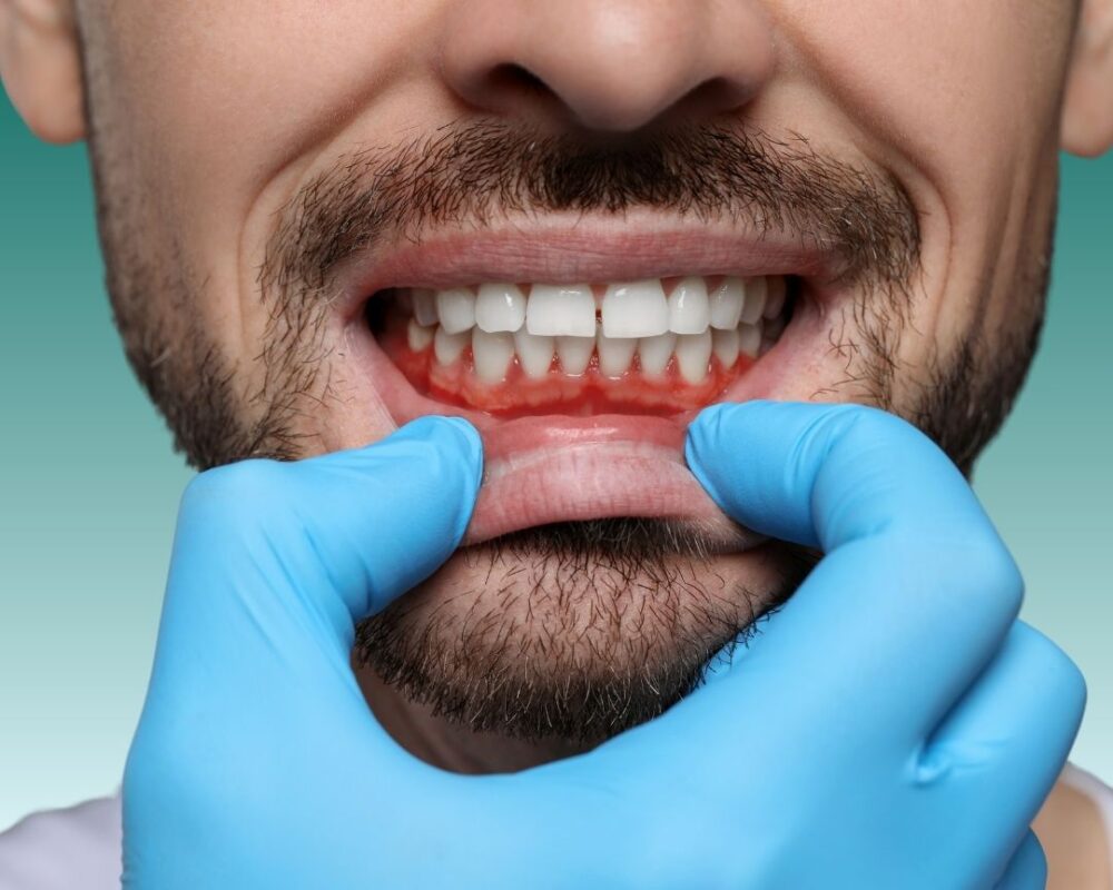 Gum Disease Treatment in Turkey | Gum Surgery | Soraca Med