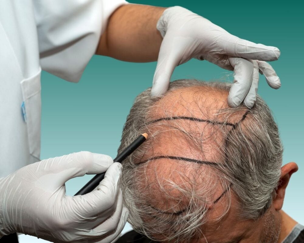 DHI Hair Transplant Turkey | Price, Procedure, Advantages - Soraca Med