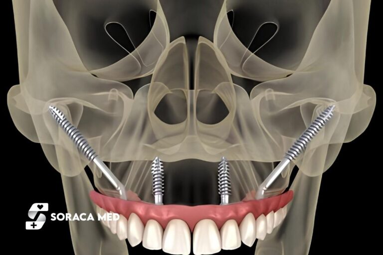 Zygomatic Dental Implants - Reviews, Procedure, Cost 2025
