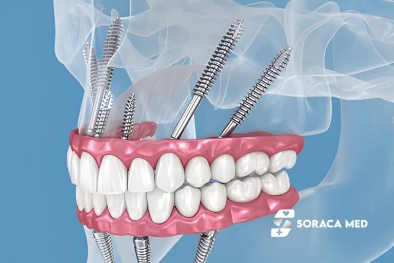 Zygomatic Dental Implants - Reviews, Procedure, Cost 2025